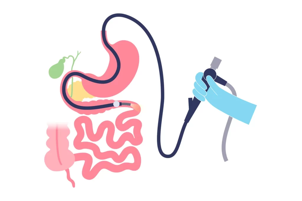 Case Study: Laparoscopic Heller Cardiomyotomy with DOR Fundoplication ...